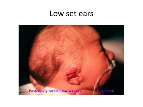 Low set ears