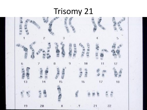 Trisomy 21