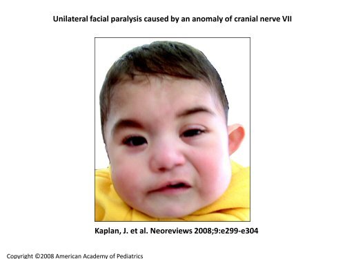 Cranial Nerve Anomalies