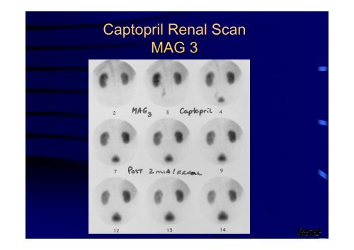 Captopril Renal