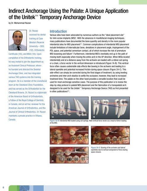 Indirect Anchorage Using the Palate - Palladium Orthodontics