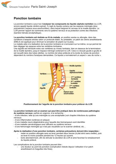 Douleur Ponction Lombaire | Étapes D’Une Ponction Lombaire – XVPVKE