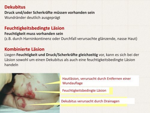 Dekubitus