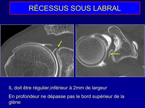 RÉCESSUS SOUS LABRAL IL