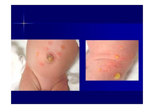 Extensive impetigo • Sy