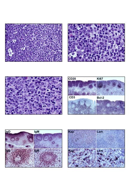 CD20 Ki67 CD3 Bcl-2 IgD I