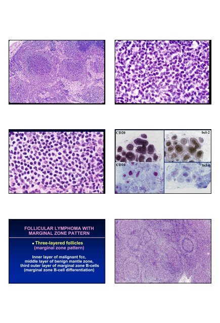 CD20 bcl-2 CD10 bcl-6