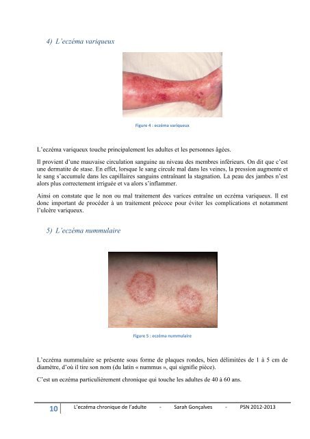 4) L’eczéma variqueux