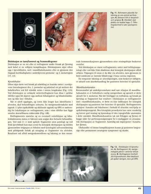 Fig. 11. Rehrmann-plastik
