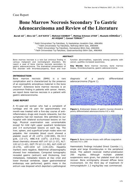 Bone Marrow Necrosis Secondary To Gastric Adenocarcinoma and ...