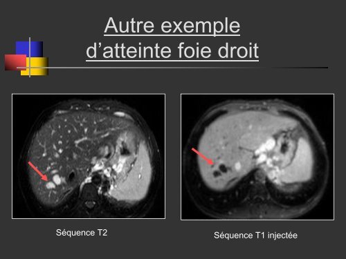 Autre exemple d’atteint