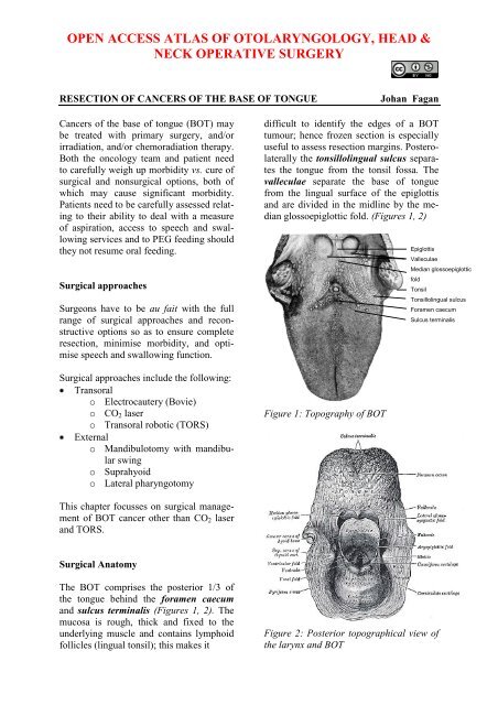 Base of tongue cancer resection - Vula - University of Cape Town