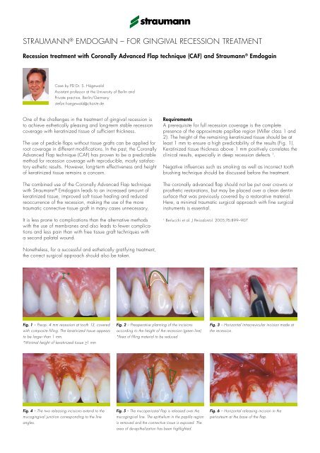 Brushing Technique For Gingival Recession