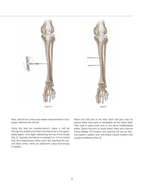 TEMPFIX ® External Fixat