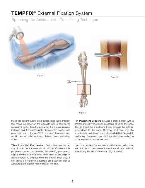TEMPFIX ® External Fixat
