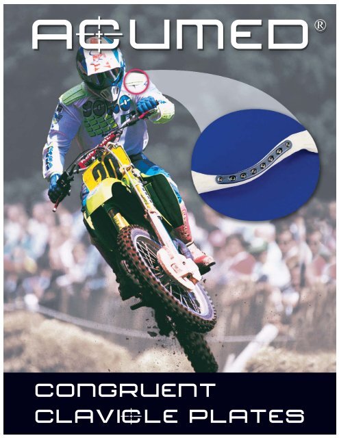 Acumed Bone plates, screws, and accessories are designed to pro ...