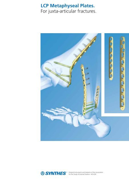 LCP Metaphyseal Plates. For juxta-articular fractures. - Osteosyntese