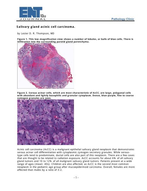 - 1 - Pathology Clinic Salivary gland acinic cell carcinoma. - Lester ...