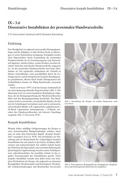 IXâ€“3.6 Dissoziative InstabilitÃ¤ten der proximalen Handwurzelreihe