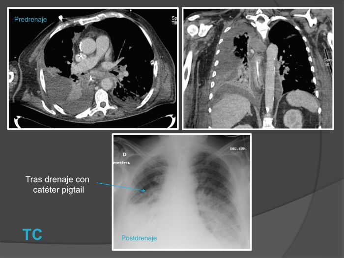 Derrame Pleural Con Catéter Pigtail