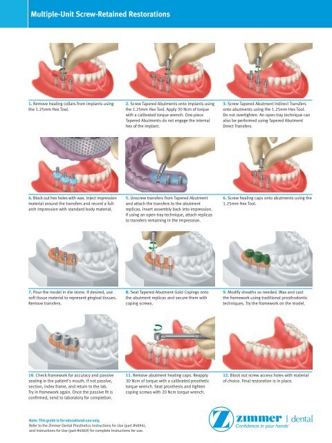 Multiple-Unit Screw-Retained Restorations - Zimmer Dental