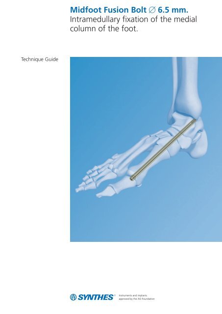 Midfoot Fusion Bolt - Synthes
