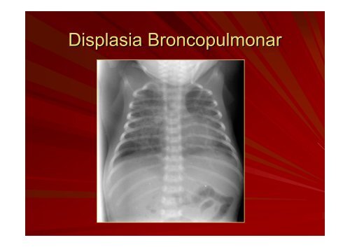 Displasia Broncopulmonar