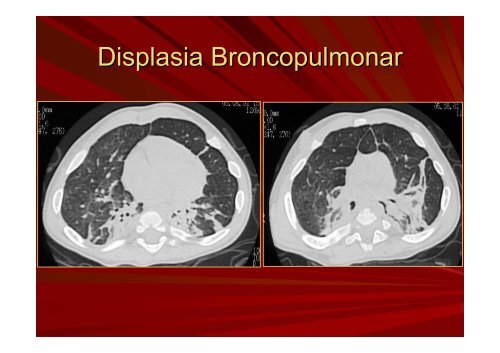 Displasia Broncopulmonar