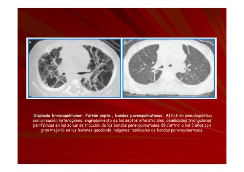Displasia broncopulmonar.