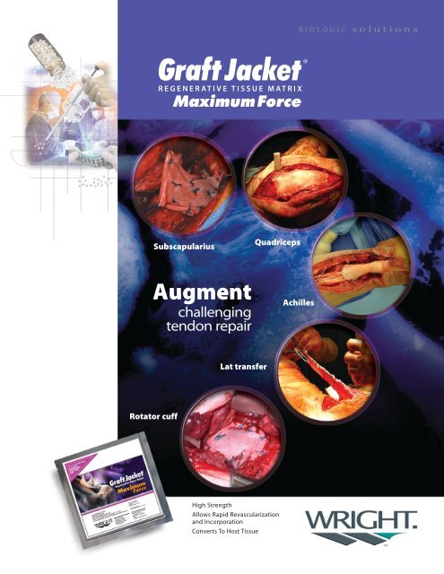 278-1103 Maxforce Graftjacket SS REV.qxd - Wright Medical ...