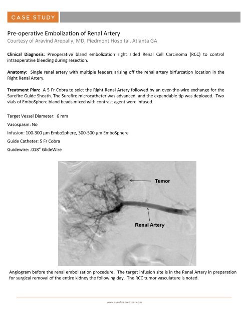 Pre-operative Embolization of Renal Artery - Surefire Medical