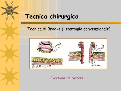 Tecnica chirurgica Tecnic