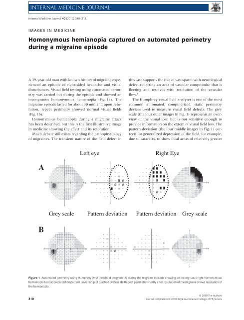 Homonymous hemianopia captured on automated ... - Pesudovs
