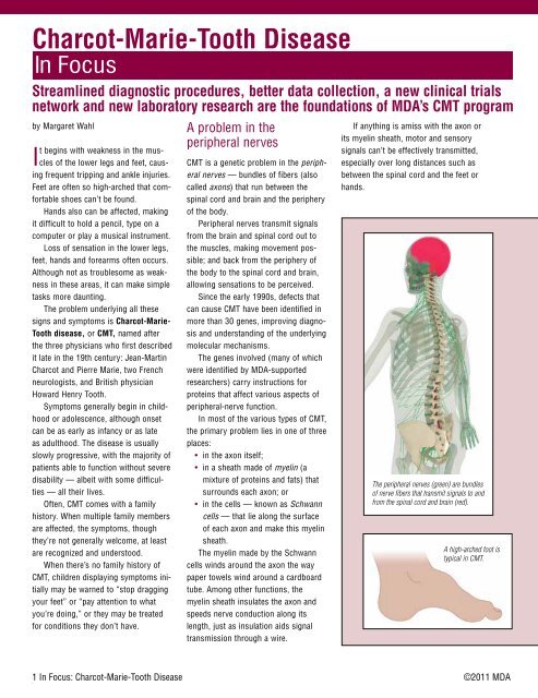 In Focus: Charcot-Marie-Tooth Disease (PDF)