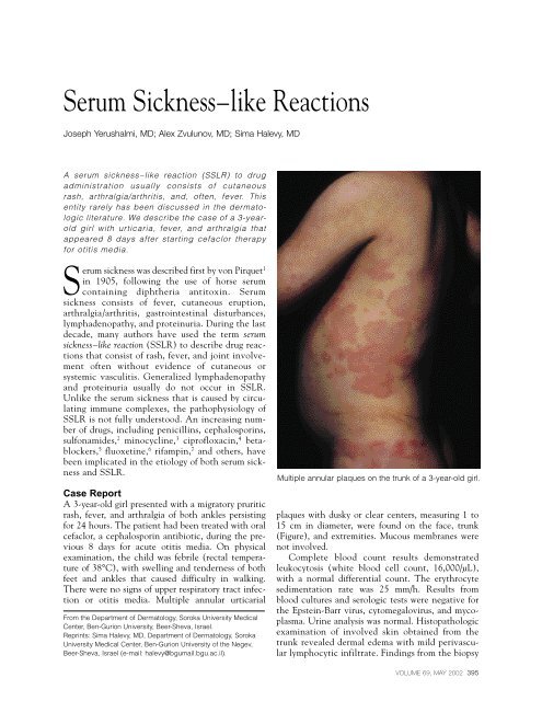 Serum Sicknessâ like Reactions - Ob.Gyn. News
