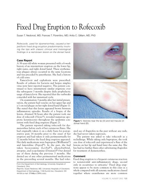 Fixed Drug Eruption to Rofecoxib - Ob.Gyn. News