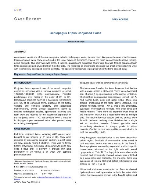 Ischiopagus Tripus Conjoined Twins - APSP Journal of Case Reports
