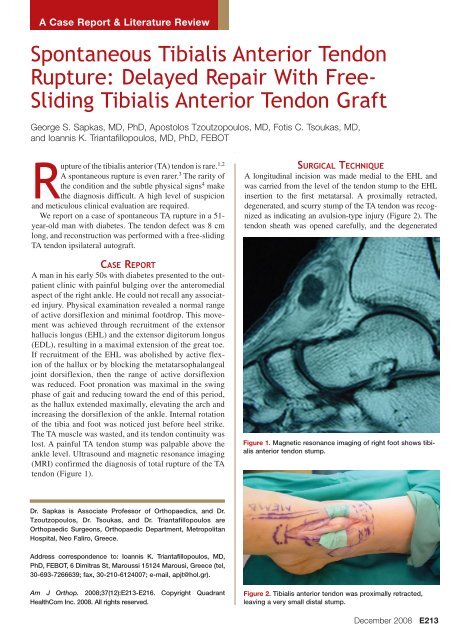 Spontaneous Tibialis Anterior Tendon Rupture: Delayed Repair ...