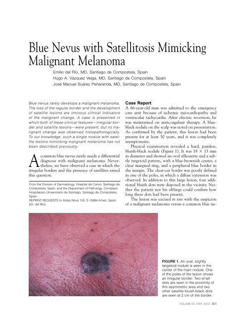Blue Nevus with Satellitosis Mimicking Malignant Melanoma - Cutis