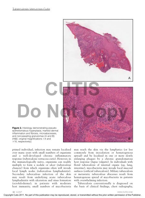 Tuberculosis
