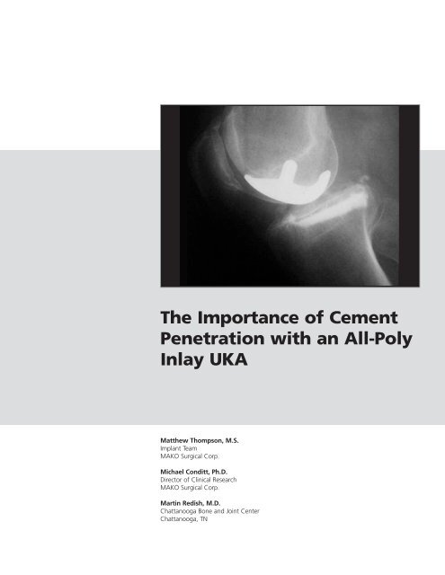 Importance of Cement Penetration with an All-Poly Inlay UKA