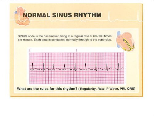 Rhythm Strip Identification Study Guide