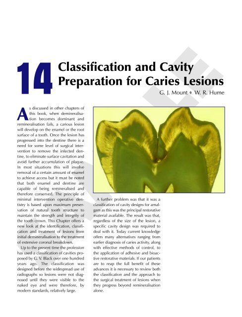 Classification and Cavity Preparation for Caries Lesions - KBS ...