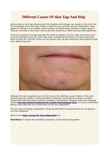 Different Causes Of Skin Tags And Help