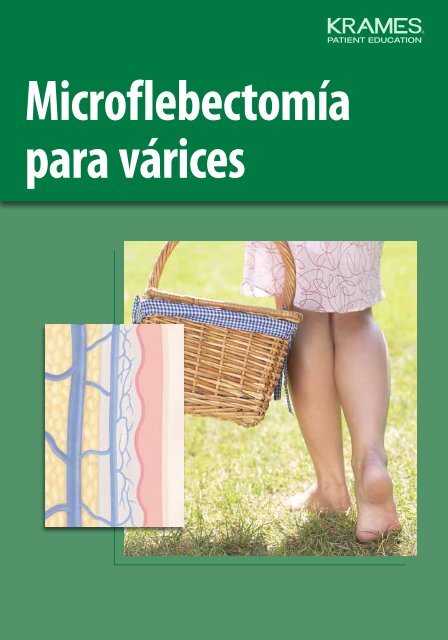Microflebectomía para várices - Veterans Health Library
