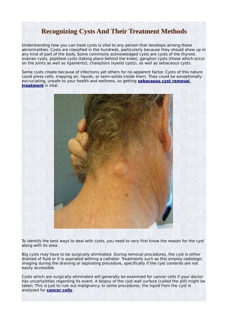 Recognizing Cysts And Their Treatment Methods