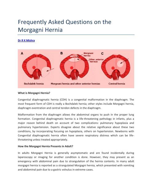 Frequently Asked Questions on the Morgagni Hernia - World ...