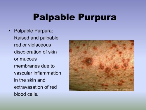 Palpable Purpura