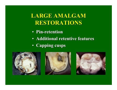 Pin Placement for Amalgam