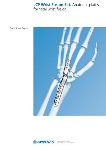 The Locking Calcaneal Plate. Part of the Synthes small fragment ...